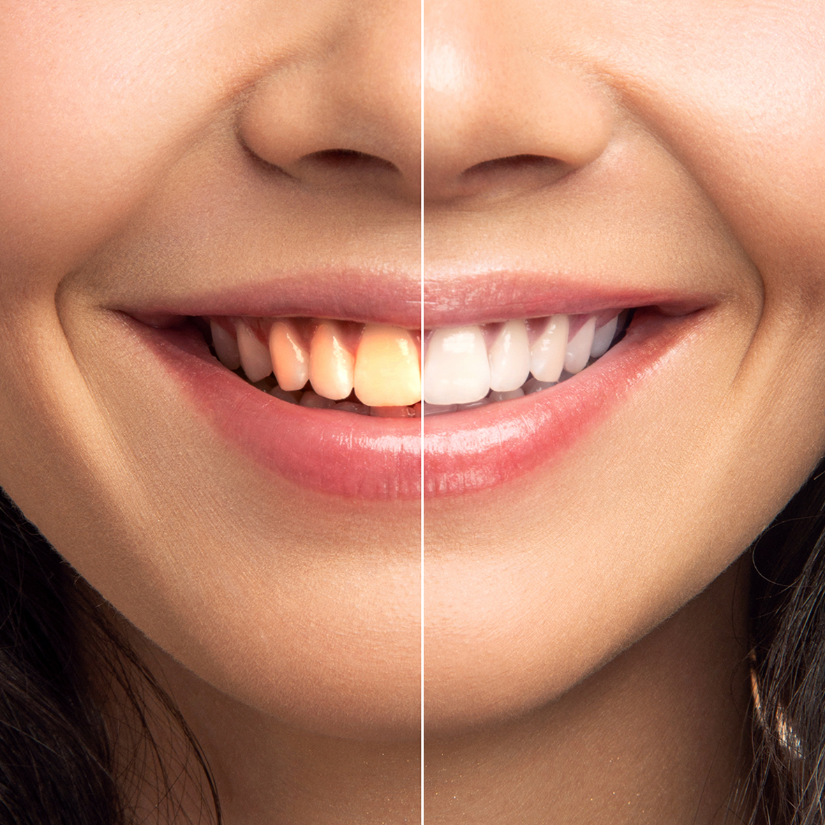 RENEW Whitening - Tower Hill Dental